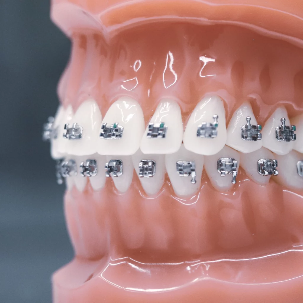 Aparat ortodontyczny Szczecin - Sanadent